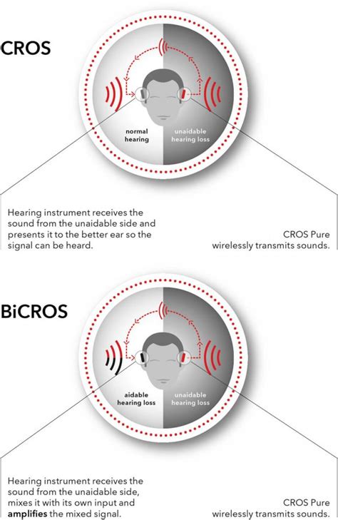 What Is Unilateral Hearing Loss Aka Single Sided Deafness