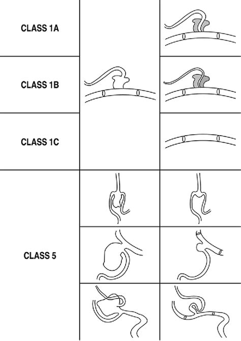 Figure 1 From A New Aneurysm Occlusion Classification After The Impact Of Flow Modification