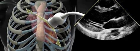 Critical Care Echocardiography Course Tte Sep Nov 2024 Royal Melbourne Hospital Parkville