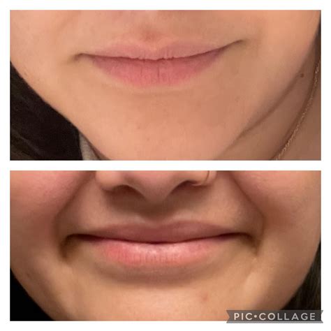 Tmj Botox Regrets R Tmj