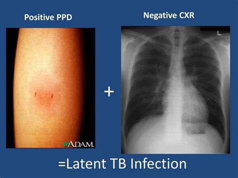 What To Do With Positive Ppd And Negative Chest X Ray At Russell