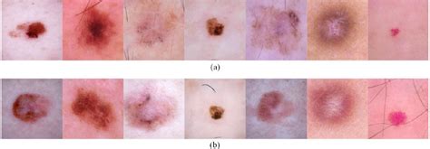 Figure 1 From A Gan Based Data Augmentation Method For Imbalanced Multi Class Skin Lesion