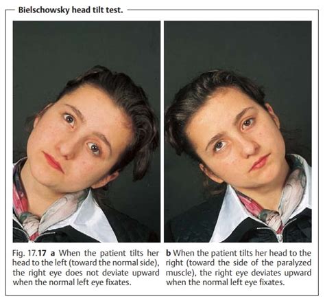 Ophthalmoplegia And Paralytic Strabismus