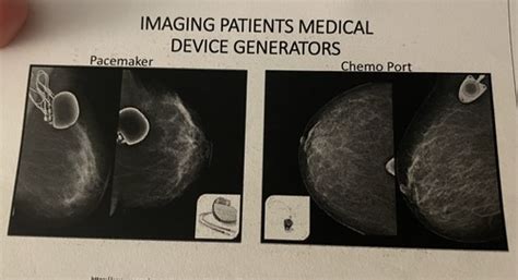 Arrt Mammography Requirement Outline Topics Procedures Part 2