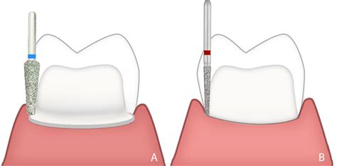 Illustration Showing The Difference Between A Conventional And B