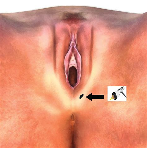 Extrakorporeální rázová vlna v terapii indukované proLékaře cz