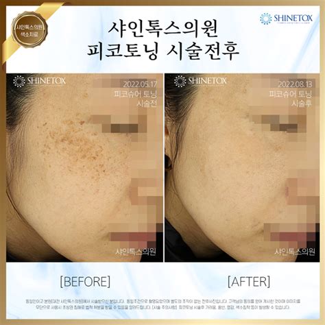 피코토닝 전후사진 대전둔산 샤인톡스의원