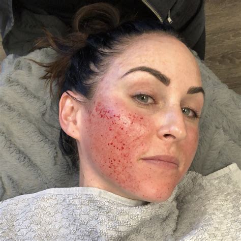 My Experience W Microneedling And Why Im Obsessed Paleomg