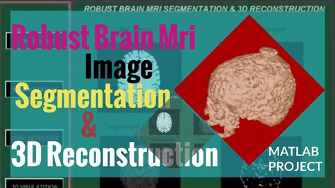 MRI Image Processing Segmentation D Reconstruction By Using Matlab