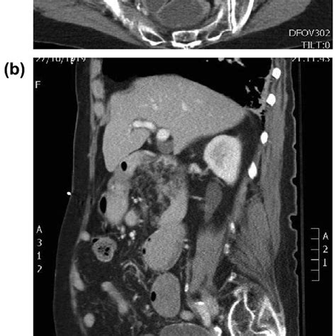 Radiology Of Tube Ileostomy Site Without Any Sign Of Stricture Or Leakage Download Scientific