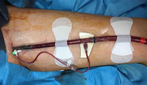 Percutaneous Ecmo Cannulation Alfred Ecmo Guideline