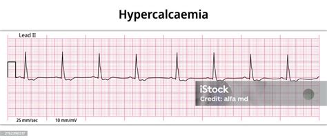 Ecg Hypercalcaemia Hypercalcemia 8 Second Ecg Paper Electrocardiogram
