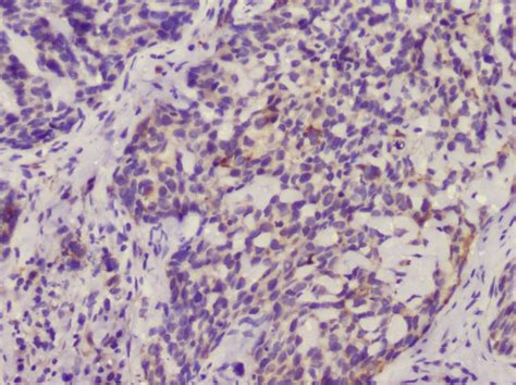 P16 Expression Was Only Focally Positive Original Magnification ×10