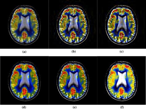 Mri T2 And 18f Fdg Image Fusion By Wavelet Transform Nsct Nsct Pcnn Download Scientific