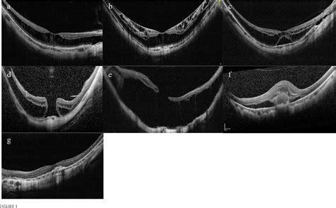 figure 1 from development of a deep learning algorithm for myopic
