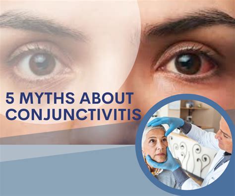 5 Myths About Conjunctivitis Florida Eye Microsurgical Institute