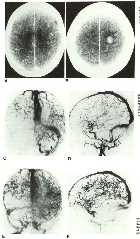 figure 1 from transverse and sigmoid sinuses high risk dural arteriovenous fistulae of the