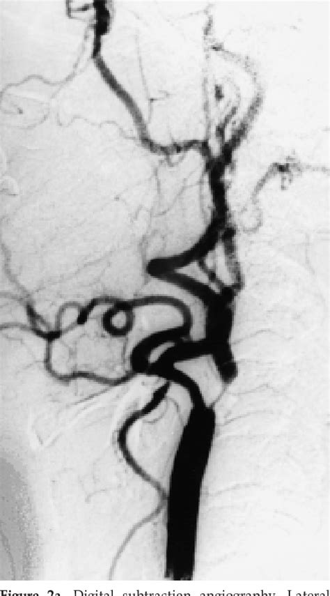 Pdf Cerebral Hyperperfusion Syndrome After Carotid Angioplasty