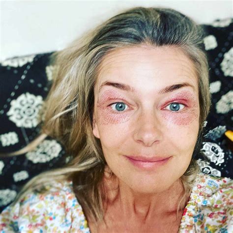 Paulina Porizkova Shows Aftermath Of Skin Tightening Treatments
