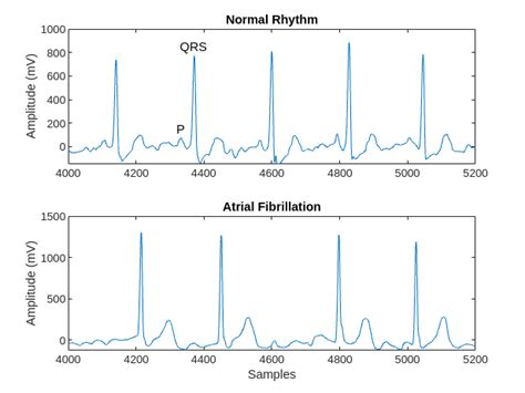 Classify Ecg Signals Using Long Short Term Memory Networks With Gpu Acceleration