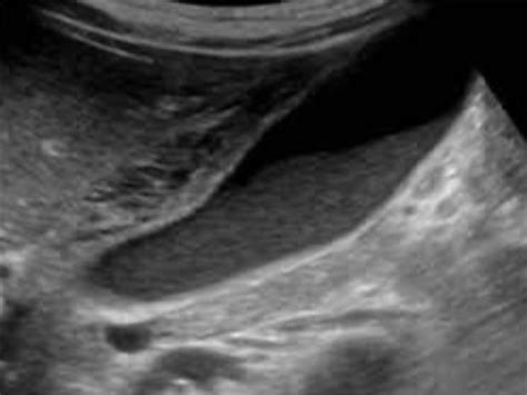 Gallbladder Sludge Sonographic Tendencies