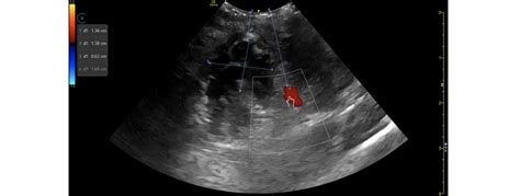 Guide On Pocus For Pta — Usf Emergency Medicine