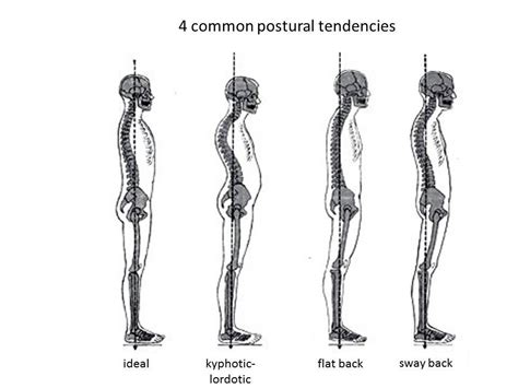 Postural Tendencies Ideal Kyphotic Lordotic Sway Back And Flat Back Lower Back Muscles