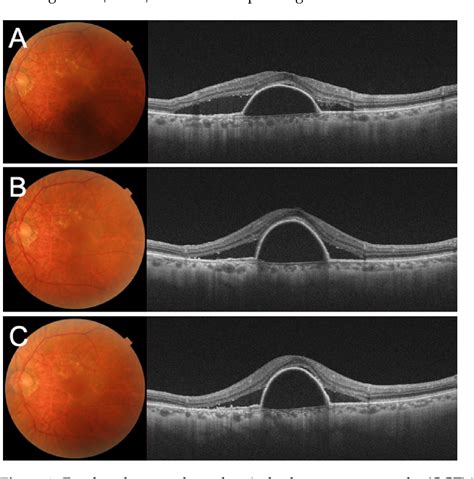 Figure 2 From Intraocular Inflammation Secondary To Intravitreal Brolucizumab Injection For