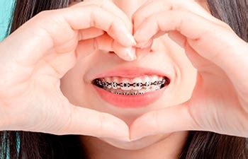 Types Of Braces Schatz Orthodontics