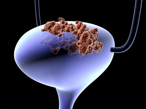 Urovysion Results Predict Post Bcg Bladder Cancer Outcomes Renal And