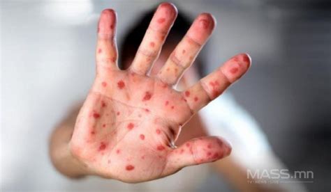 ХӨСҮТ Улаанбурхан өвчний 93 дахь тохиолдол лабораториор батлагдлаа