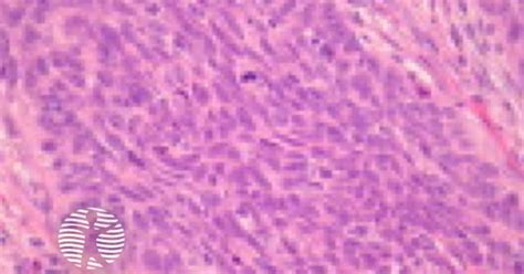 Basaloid Scc Fig 34 Sm Image