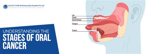 Mouth Cancer Surgery Diagram Submental Island Flap Reconstruction