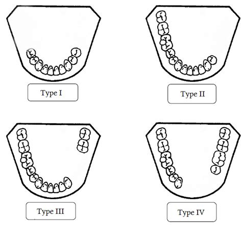 Kennedy Classification News Dentagama