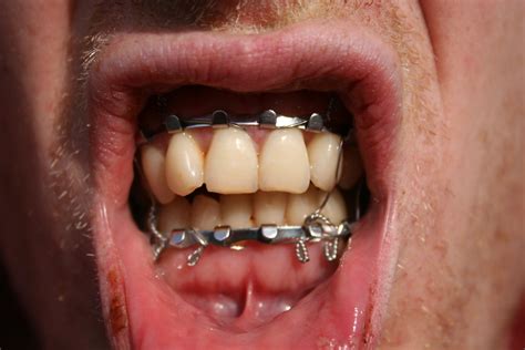 Broken Jaw Wired Shut