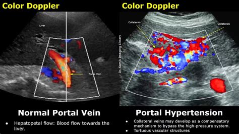 Porta Hepatis Ultrasound Stepwise Evaluation Of Liver Sectors And