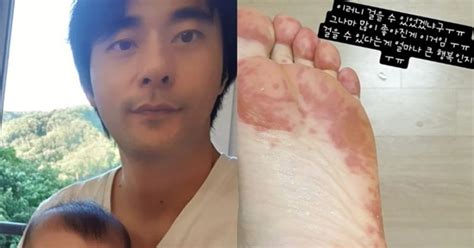 김예린♥ 윤주만 수포 가득한 발바닥 걸을 수 있었겠냐구