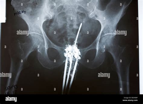 X Ray Brain Tumor