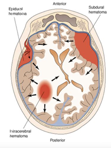 Tbi Flashcards Quizlet
