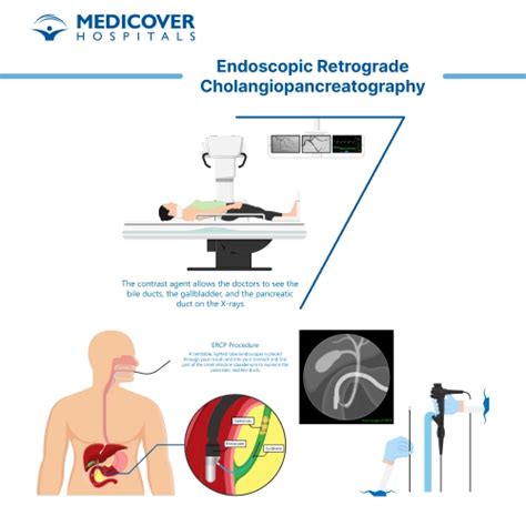Ercp Wskazania Przygotowanie I Rekonwalescencja