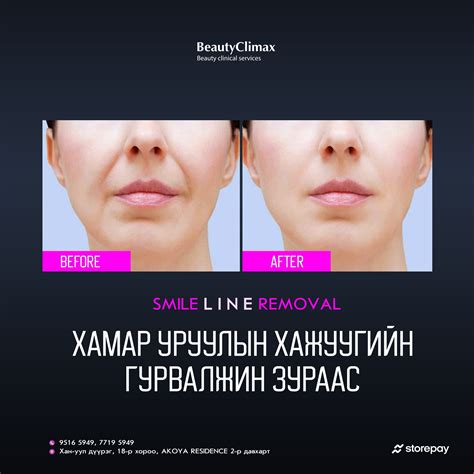 Beauty 🤗 НЭГ ОРОЛТЫН ҮР ДҮН ХАМАР УРУУЛЫН ХАЖУУГИЙН ГУРВАЛЖИН ЗУРААСГҮЙ Л БОЛ ХЭДЭН НАСААР