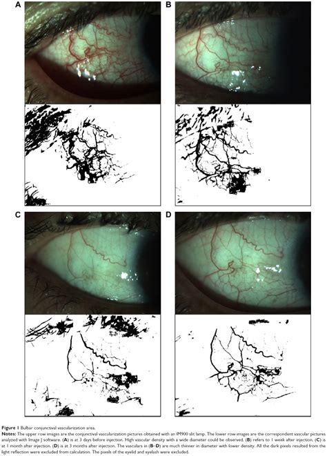 Efficiency And Safety Of Subconjunctival Injection Of Anti Vegf Agent Dddt