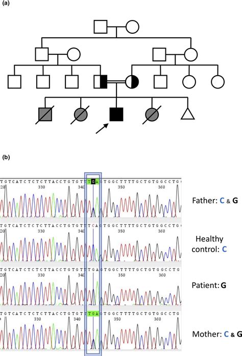 A Pedigree Of The Index Patient Showing A Typical Autosomal Recessive