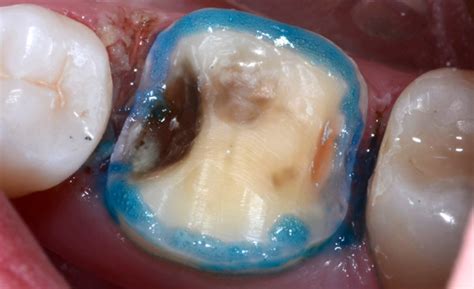 Selective Etching Of The Enamel CDOCS