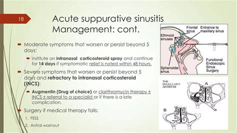 Sinusitis Pptx