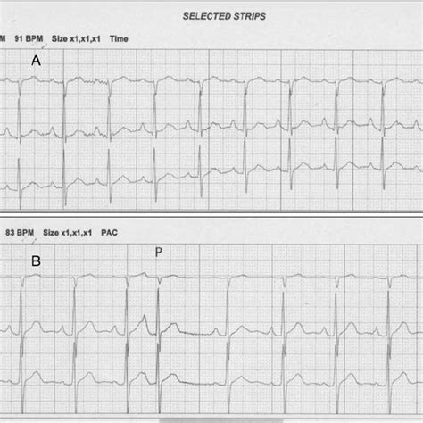 Absence Of Relationship Between Peak T Wave Alternans And Corresponding Download Scientific