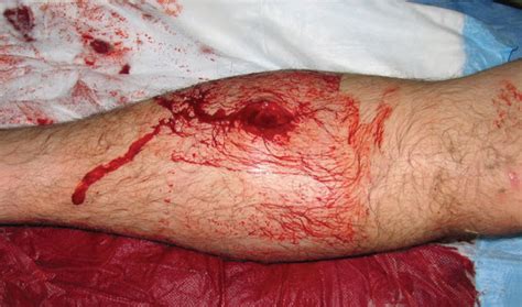 Tibia Fracture With Compartment Syndrome OrthopaedicsOne Cases