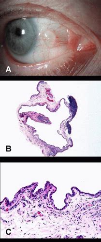 Pathology Of Conjunctiva Ento Key