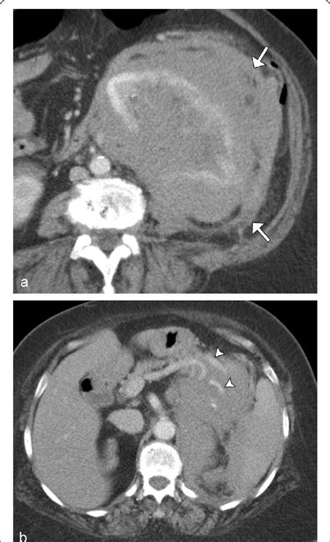 Perinephric Space Infiltration Of Renal Lymphoma Axial CT Of The Download Scientific Diagram