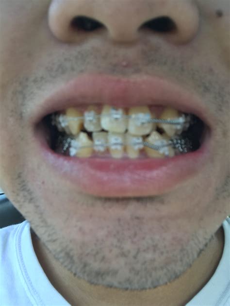 First Day Of Braces Scrolller